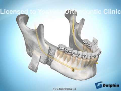 Mandibular Setback - YouTube