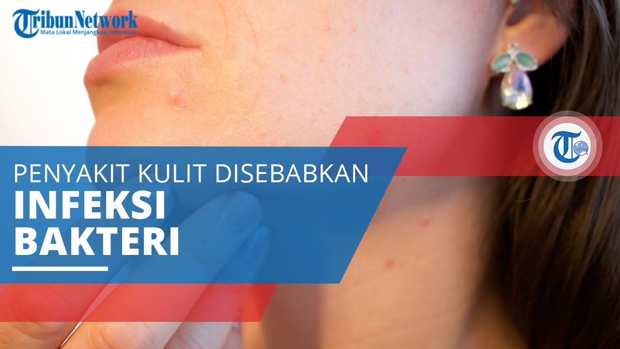 Impetigo, Penyakit Kulit yang Terjadi karena Infeksi bakteri yang ...