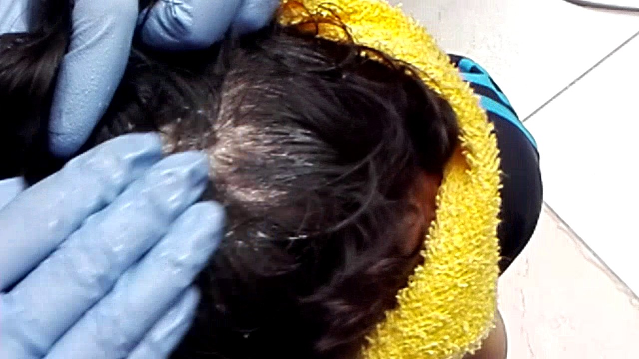 Truco para caspa y seborrea - YouTube