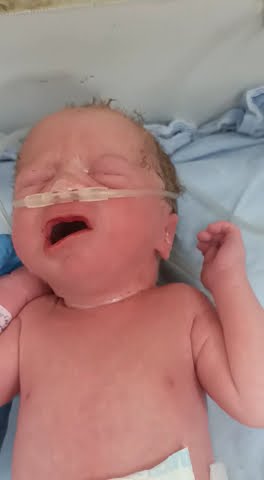 newborn baby with facial palsy - YouTube