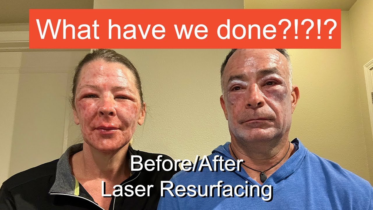 Erbium Laser Facial Resurfacing | Before & After #laserresurfacing # ...