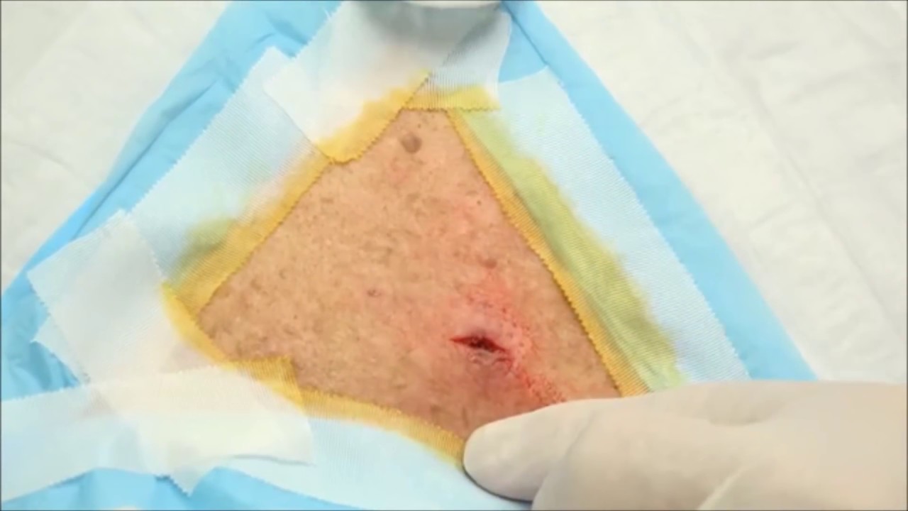 Cyst Popping - Sac Stuffed Into Cheek! - YouTube