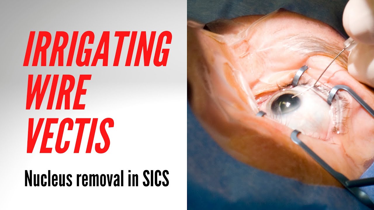 Nucleus removal in Small incision Cataract Surgery : Irrigating Wire ...