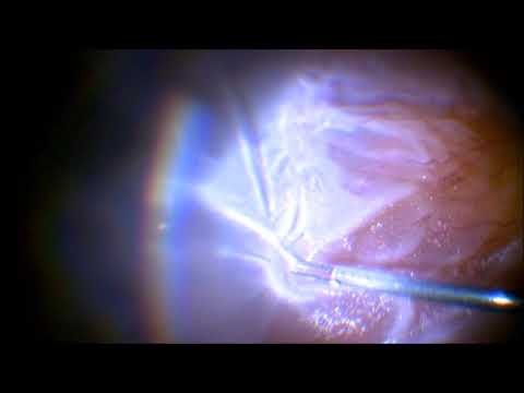 Vitrectomy for Retinal Detachment | PVR | Myopic | Buckled eye | Dr ...