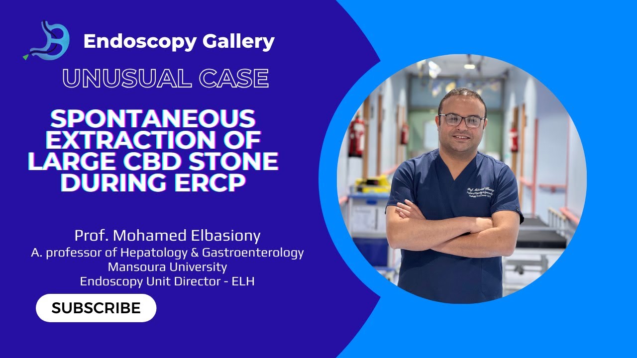 Unusual Case: Spontaneous Extraction of Large CBD Stone During ERCP - YouTube