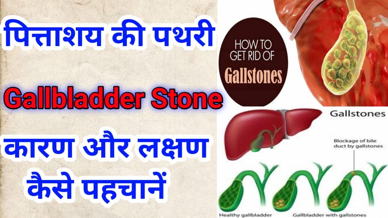 पित्ताशय की पथरी | लक्षण और कारण | कैसे पहचानें | Gallbladder Stone ...