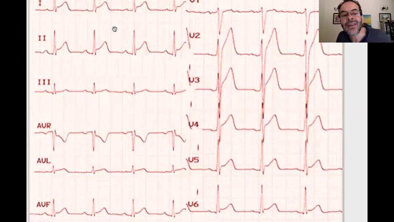 PERICARDITE COURS EXTERNES - YouTube