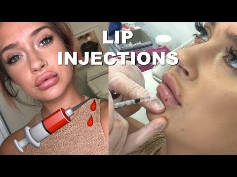 THE TRUTH ABOUT LIP INJECTIONS | SARA VIDAL