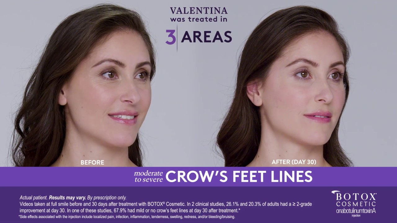 BOTOX Cosmetic Twins Campaign Patient In Office Video - YouTube