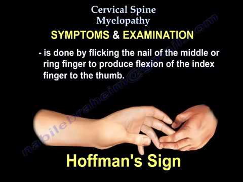 Cervical Spine Myelopathy - YouTube