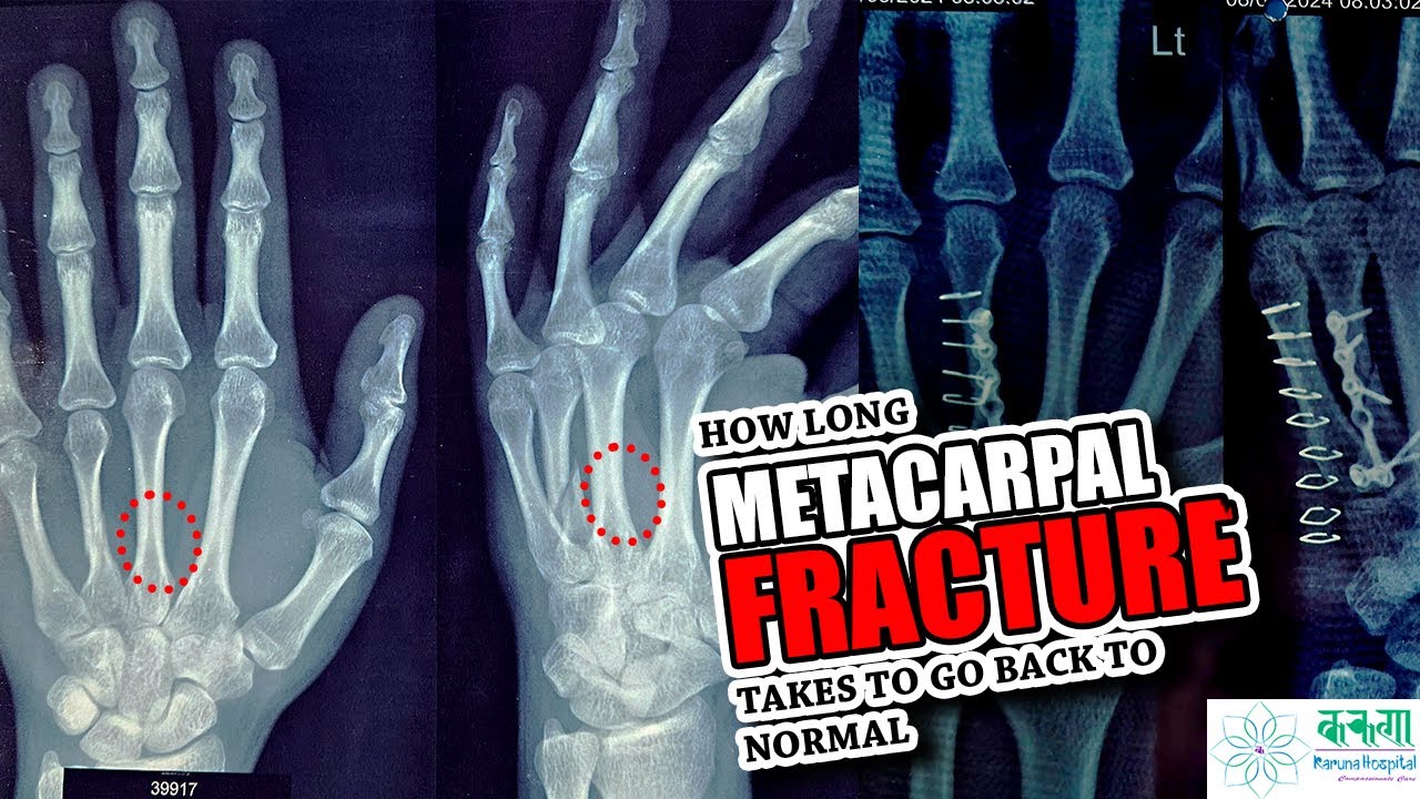 Metacarpal shaft fracture recovery story. #fracture #metacarpal #injury ...