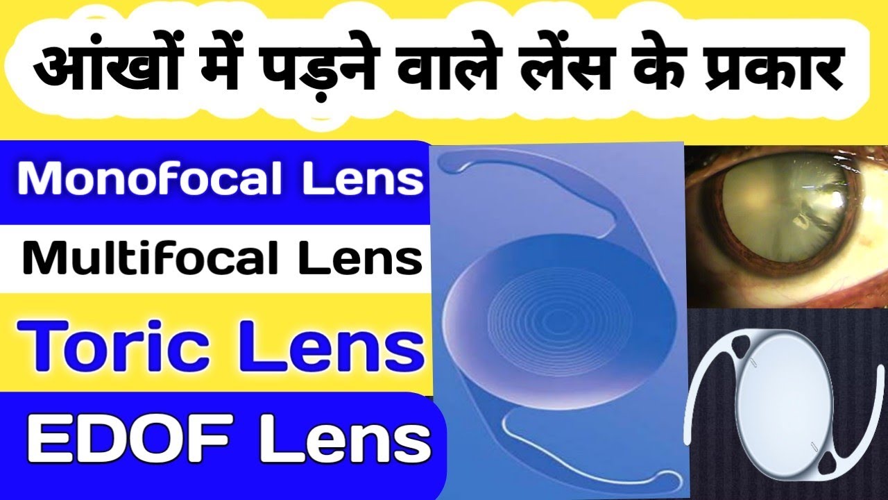 आंखों में पड़ने वाले (IOL) लेंस के प्रकार।Type of IOL lens inEye ...