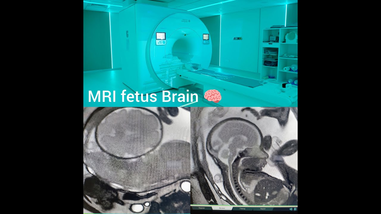 MRI fetus Brain on United imaging 3T - YouTube
