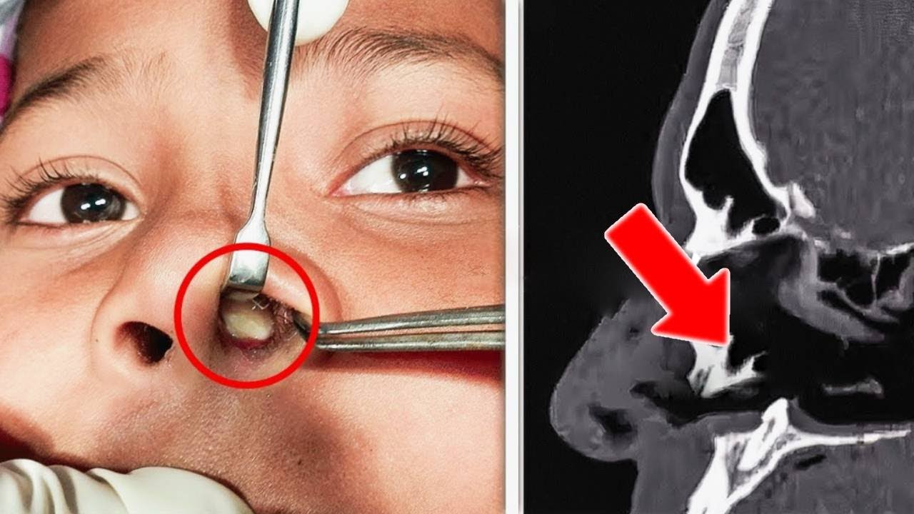 Doctors Find What's Growing Inside His Nose, After Man Has Intense Itch ...