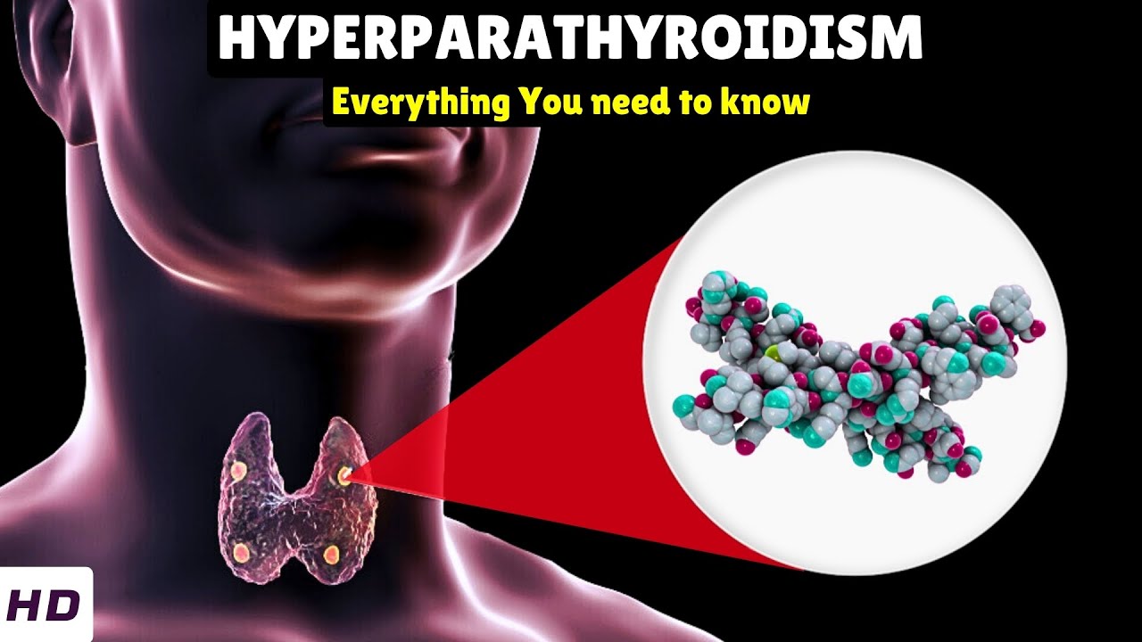 Hyperparathyroidism – Types, Causes, Signs and Symptoms, Diagnosis ...