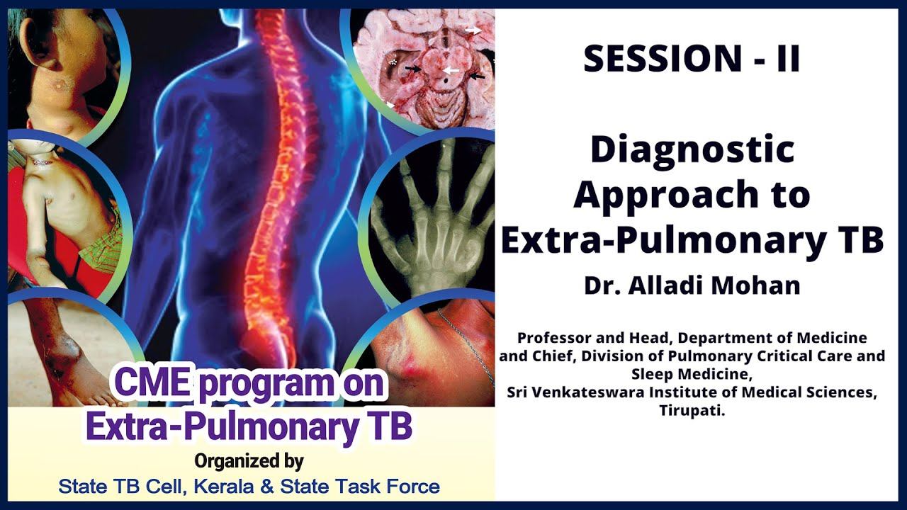 CME program on Extra-Pulmonary TB - Session II - YouTube