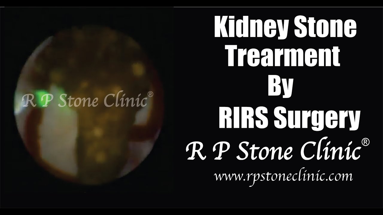Kidney Stone treatment by RIRS Surgery using Flex X2S - YouTube