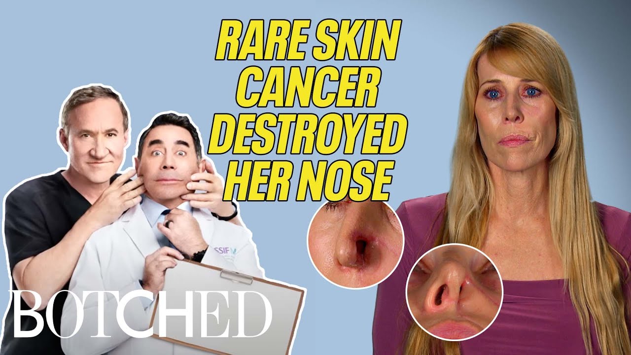Cancer Took A Bite Out of Shelley’s Nose And Left A MASSIVE Hole ...