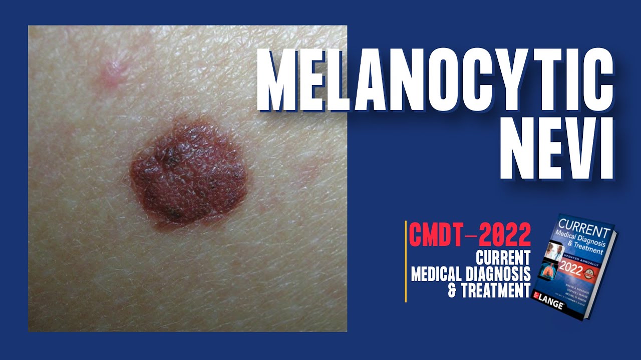 Melanocytic Nevi (Normal Moles) | PIGMENTED LESIONS | CMDT 2022 - YouTube