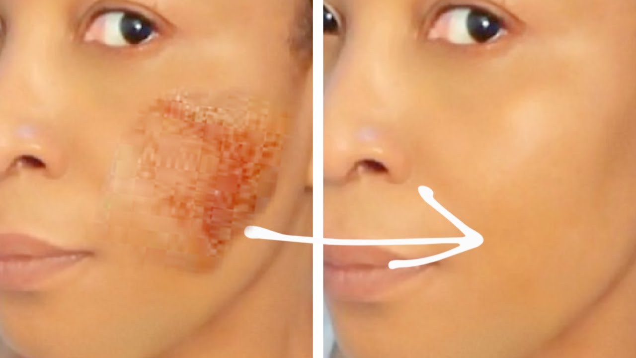 SKINCARE, HOW TO REMOVE FACE PIGMENTATION NATURALLY, Dark Spots, Black ...