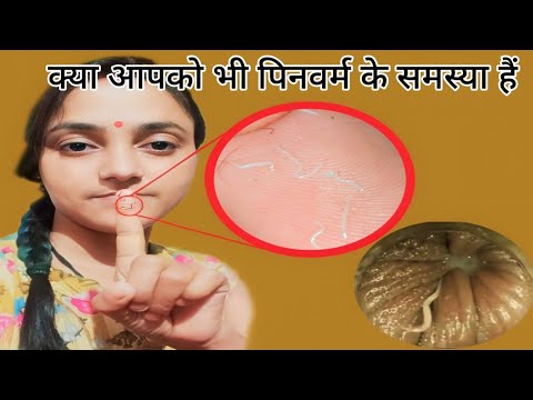 सिर्फ 1 रात मे Pinworms होगा खत्म | How to get rid of Pinworms ...