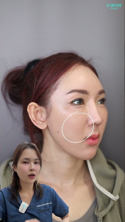 V-Won Clinic : ร้อยไหมแก้หน้าหนัก จากฟิลเลอร์!! - YouTube