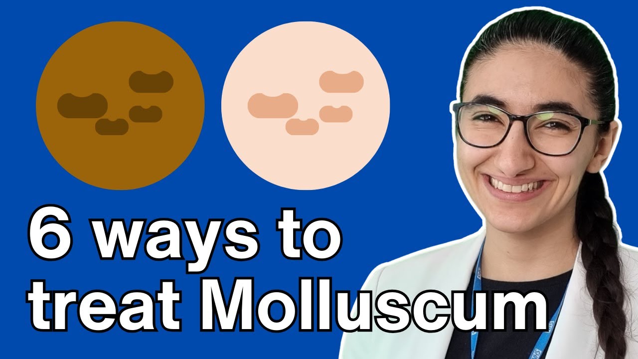 How to treat molluscum contagiosum with Pharmacist Virginia - YouTube
