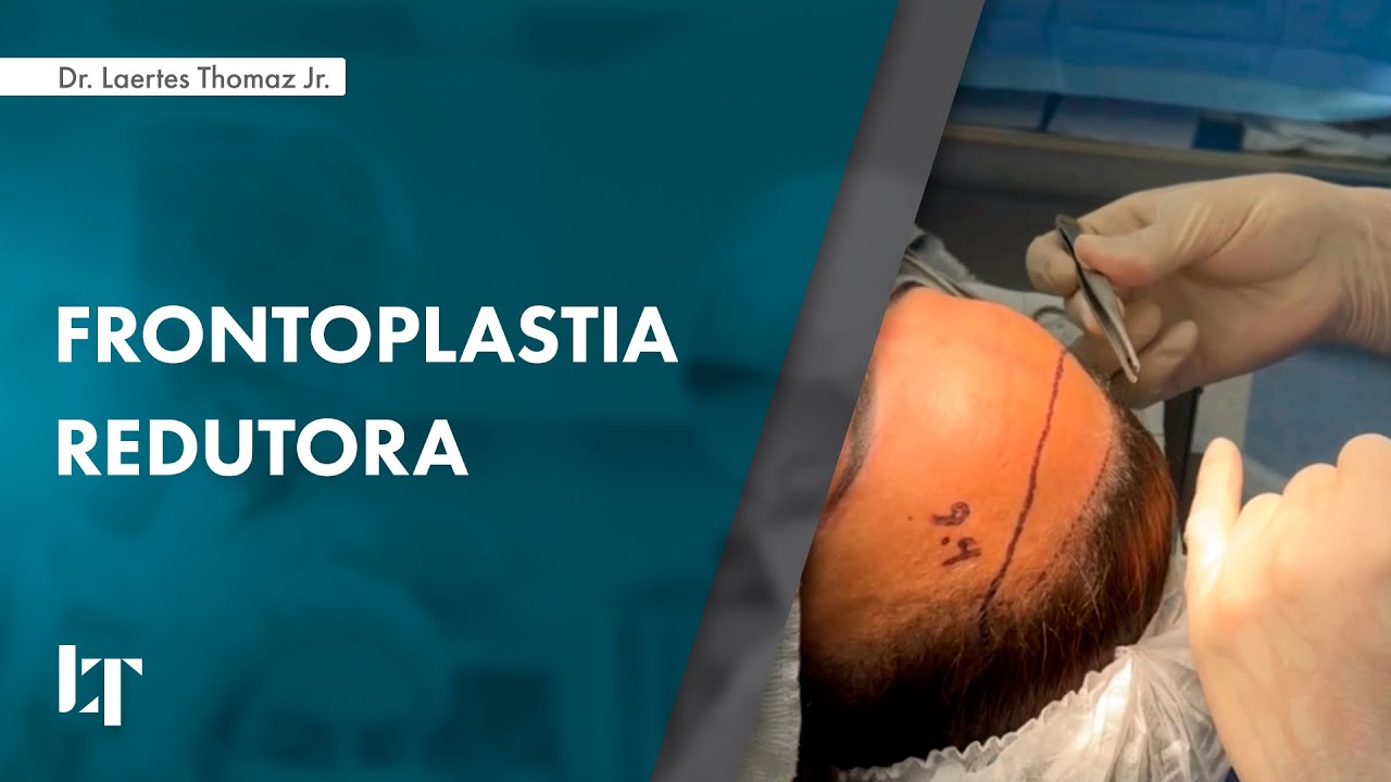 FRONTOPLASTIA REDUTORA | DR. LAERTES THOMAZ JR. - YouTube