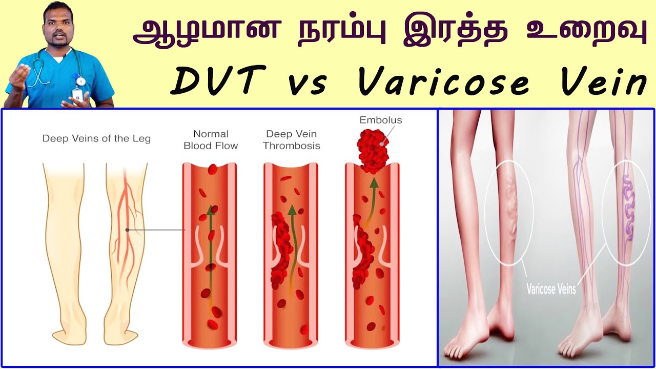 Deep Vein Thrombosis | ஆழமான நரம்பு இரத்த உறைவு | DVT vs Varicose Vein ...