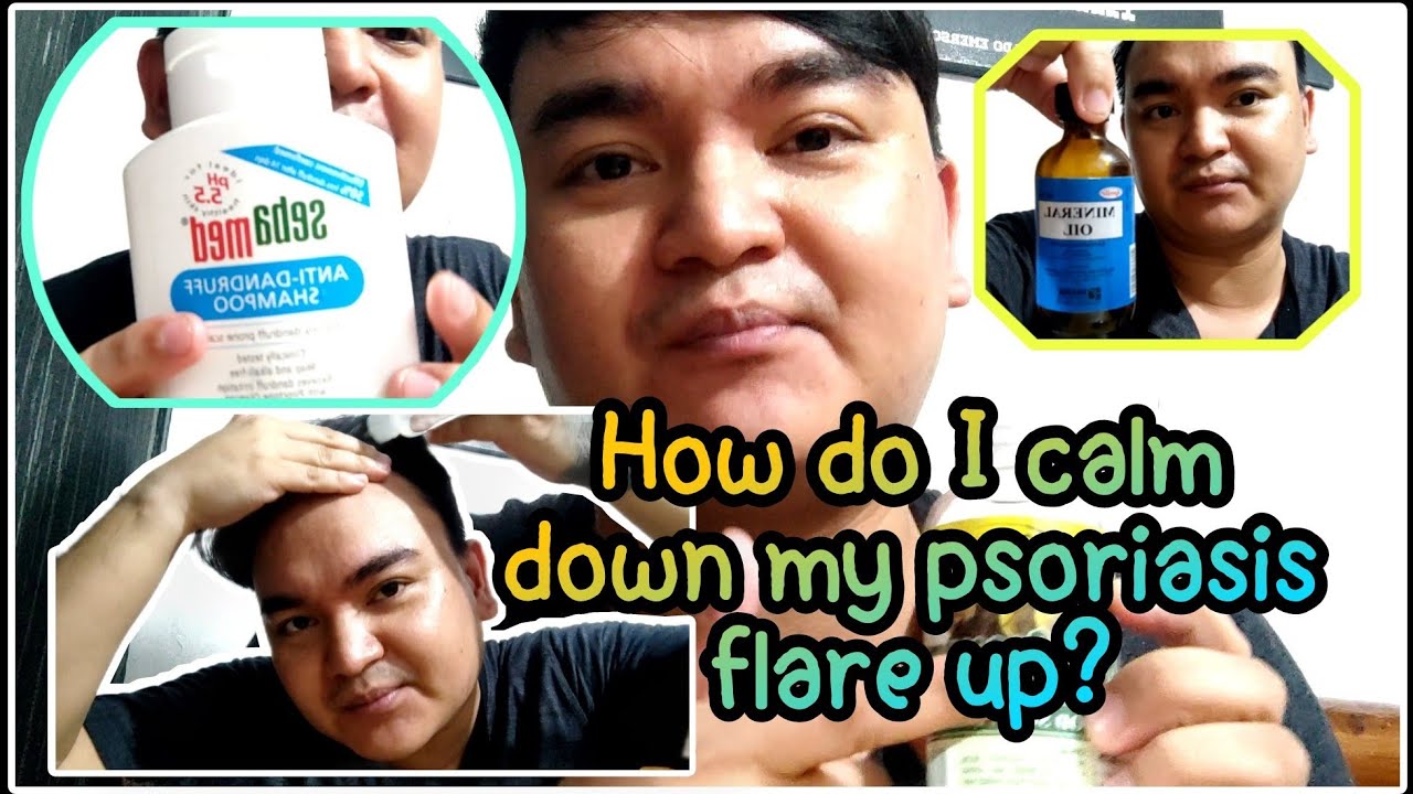 Vlog # 5 - How Do I Manage My Scalp Psoriasis? - YouTube
