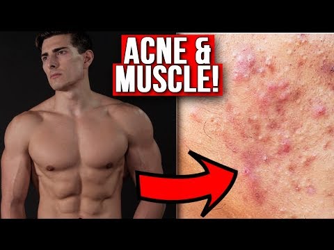 LIFE WITH ACNE | ft. Igor (Vitruvian Physique) - YouTube