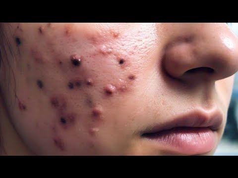 sac dep spa big deep blackheads ||ASMR facial || sac dep spa pimple ...