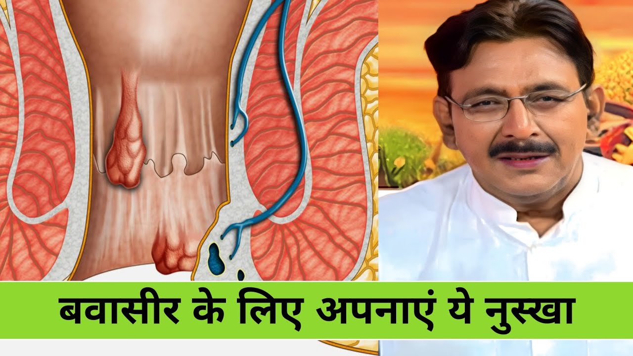 bavasir ke liye gharelu upay | By Hakim Suleman Khan | gharelu Nuskhe ...