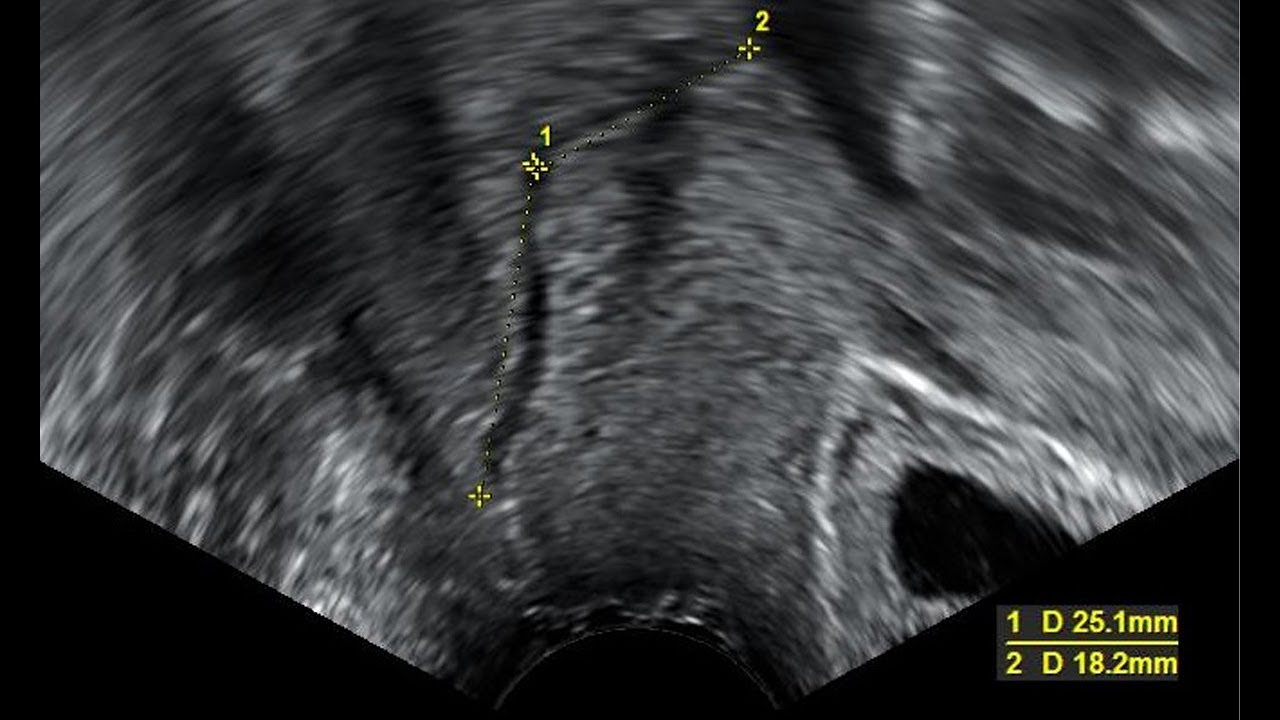 Una menor longitud cervical se vincula con mayores probabilidades de ...