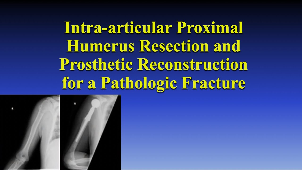 Intra-articular Proximal Humerus Resection and Prosthetic ...