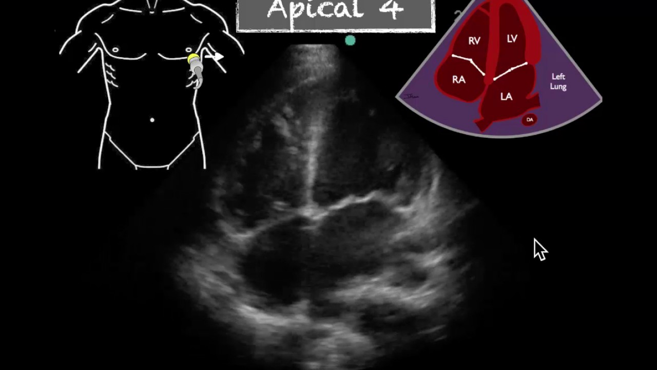 POCUS Cardiac AP4 Severely Reduced EF - YouTube