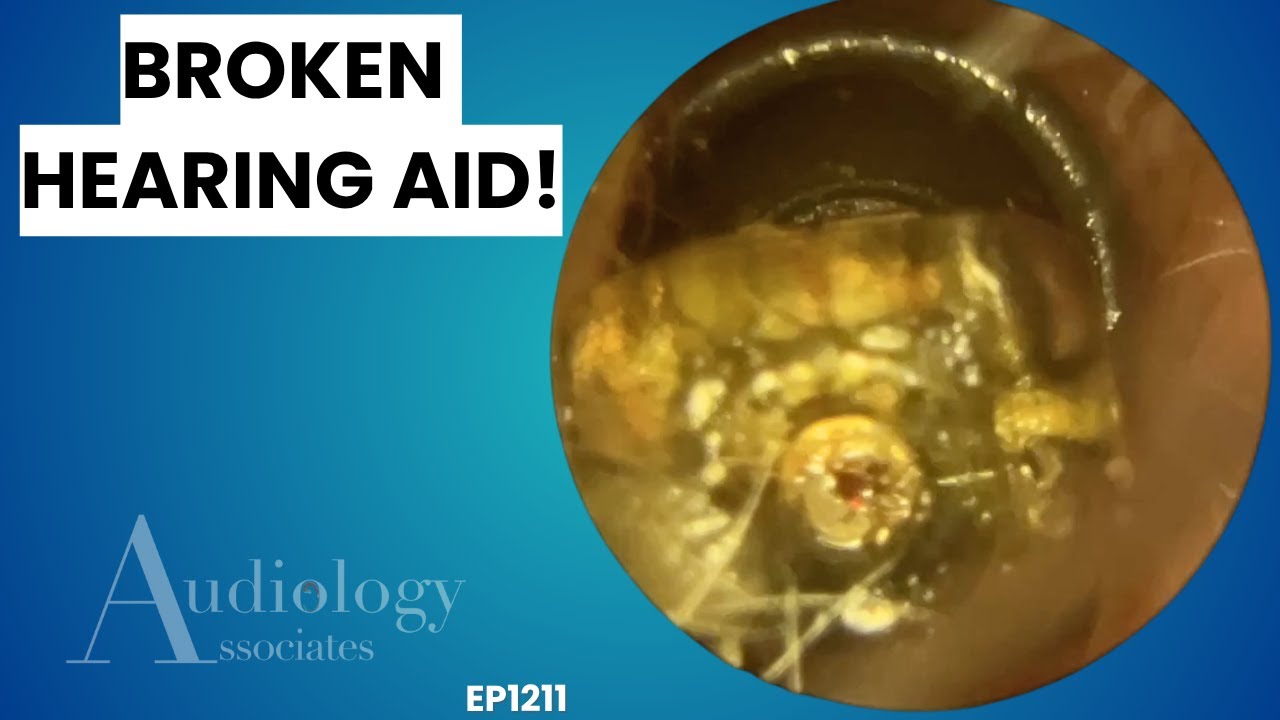 2.3 cm Plug & Broken Hearing Aid Extraction - EP1211 - YouTube