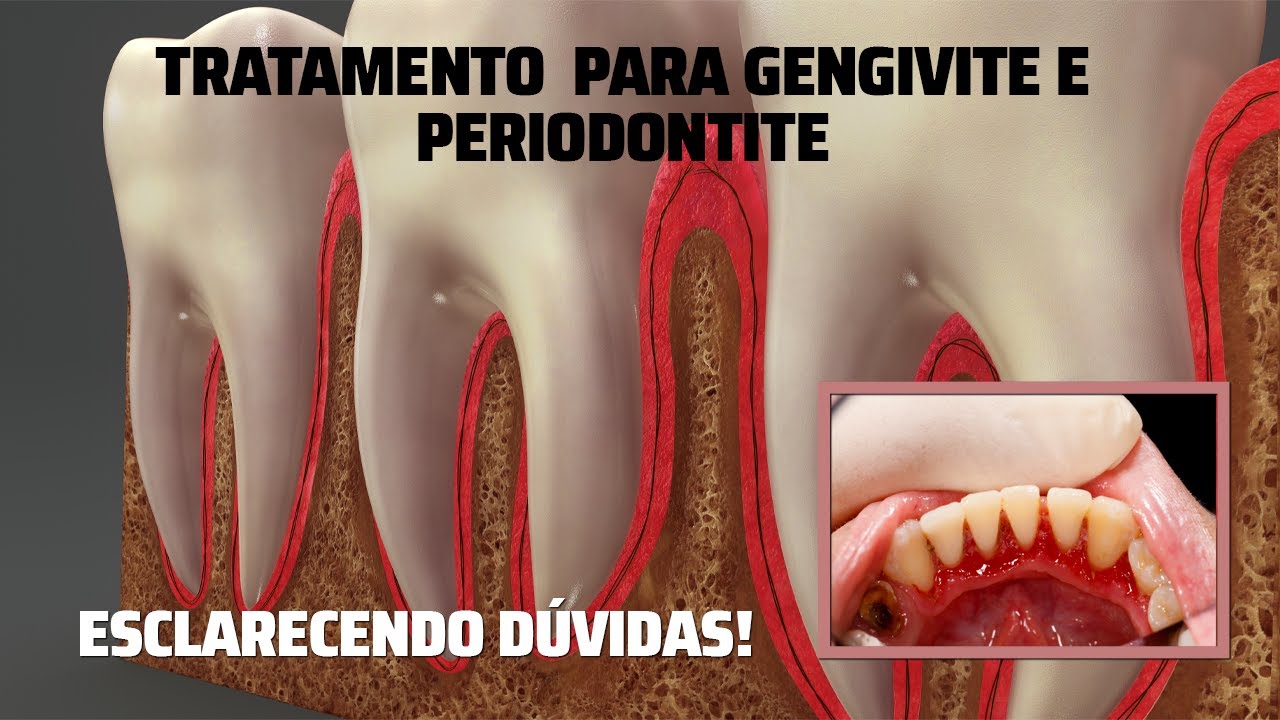 Tratamento para Gengivite e Periodontite - Esclarecendo Dúvidas - YouTube