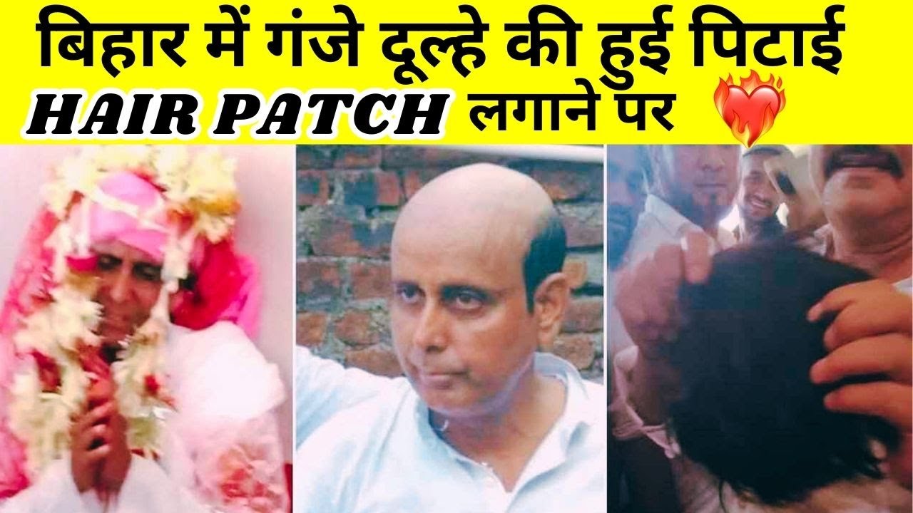 SIDE EFFECTS OF HAIR PATCH || BIHAR GUY GOT BEATEN FOR USING HAIR PATCH ...