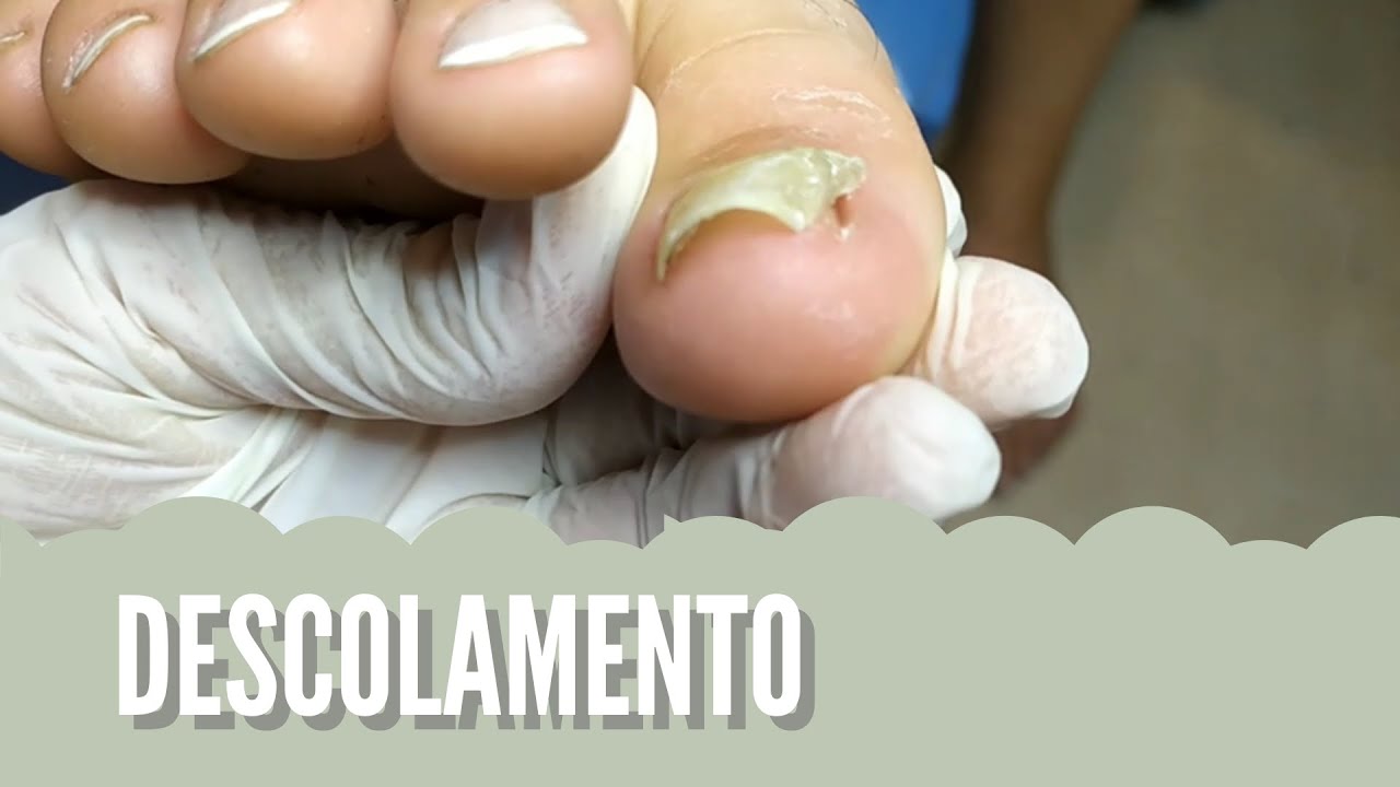 DESCOLAMENTO DE UNHA - CÉLIA LIMA - YouTube
