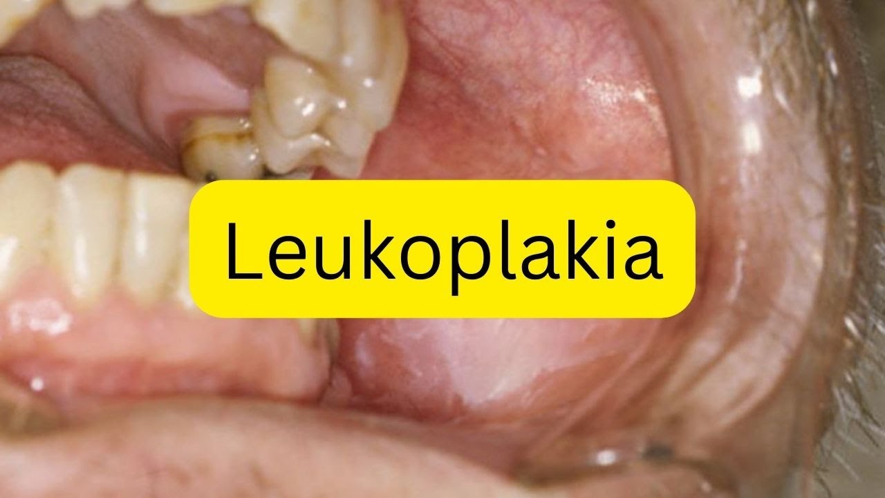What is leukoplakia? - YouTube