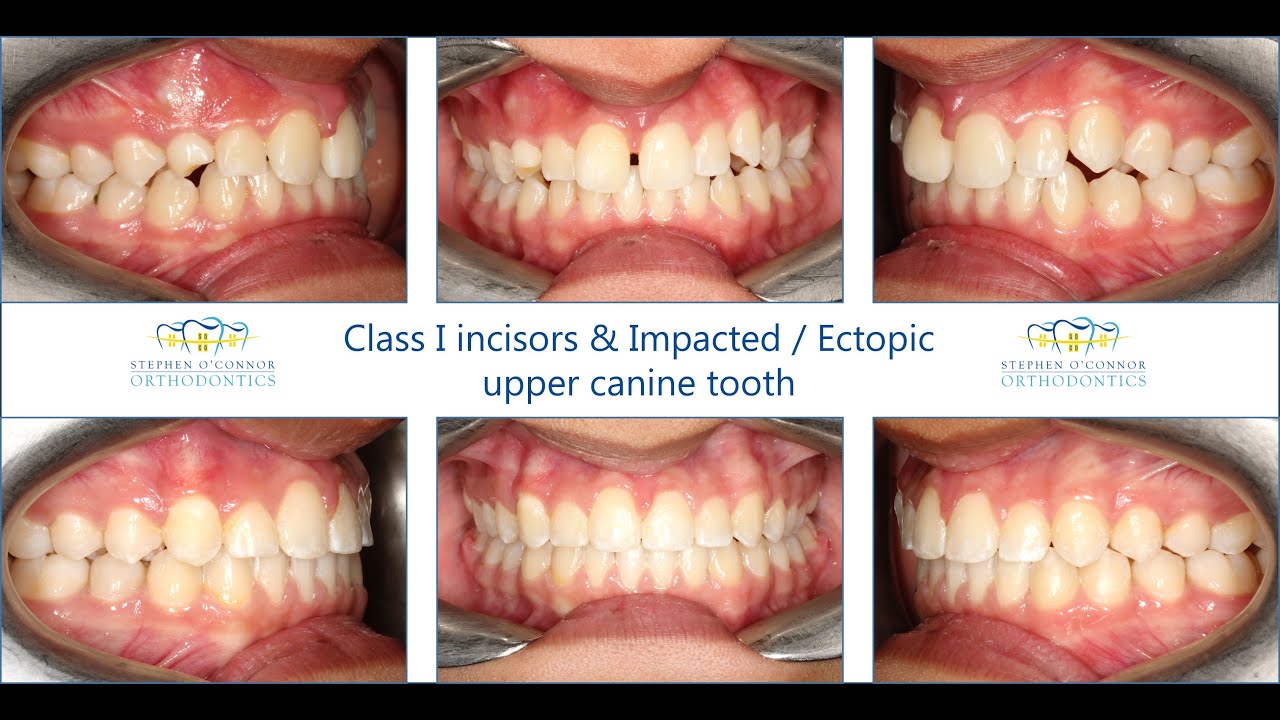 Class I occlusion & Impacted upper canine tooth - Surgical exposure ...
