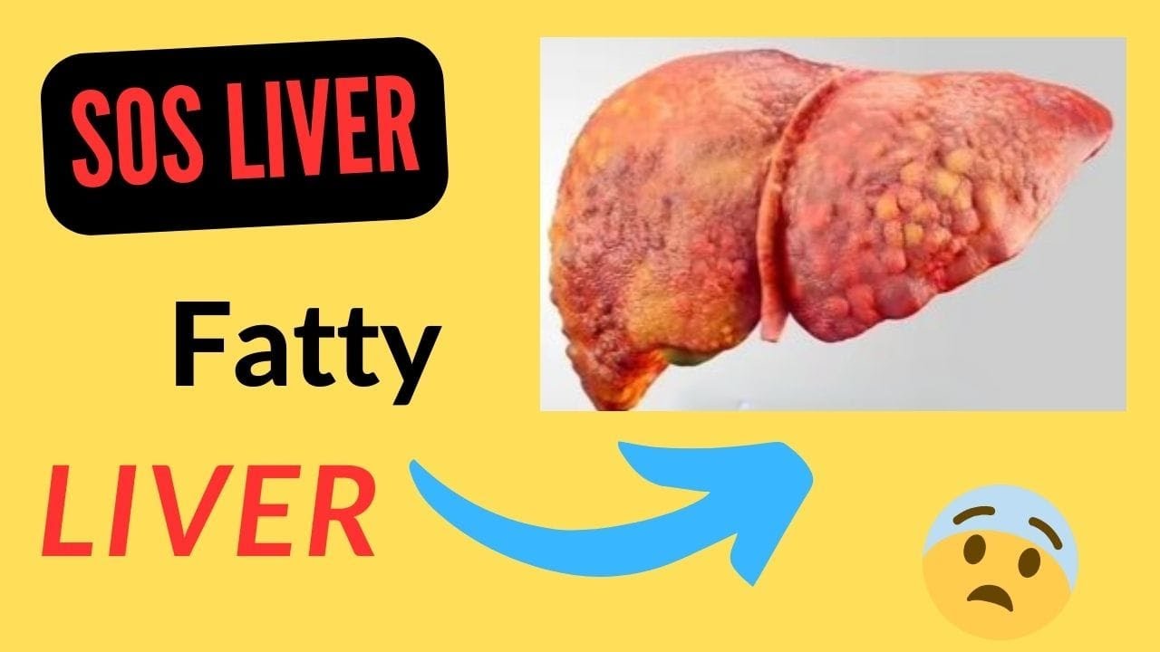SOS Liver | Fatty Liver Diet | Liver Treatment - YouTube