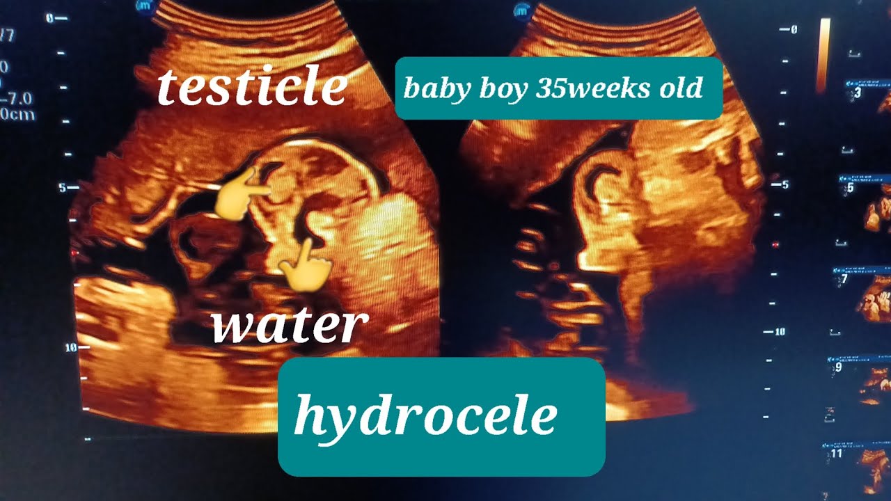 Baby boy 35weeks old with hydrocele. #ultrasound #baby #babyboy # ...