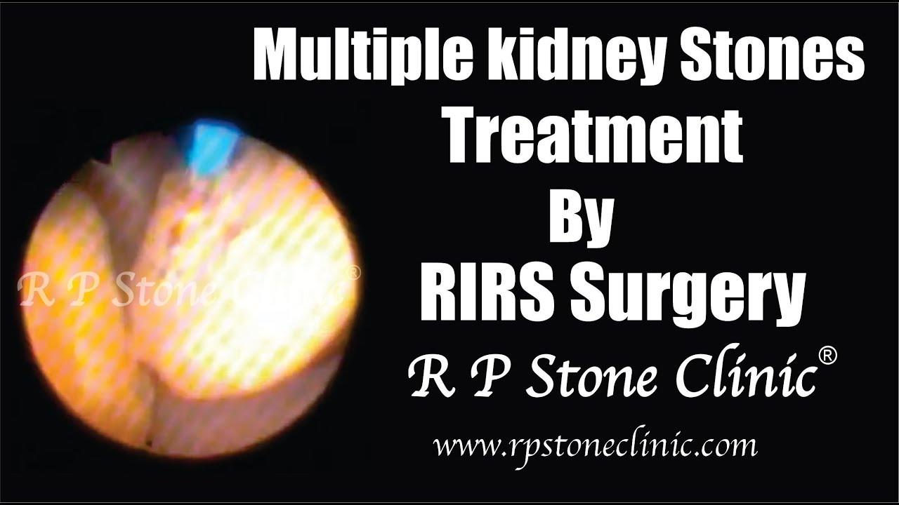 Multiple Kidney Stones treated by RIRS Surgery - YouTube