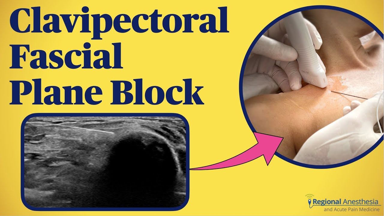 Clavipectoral Fascial Plane Block - YouTube