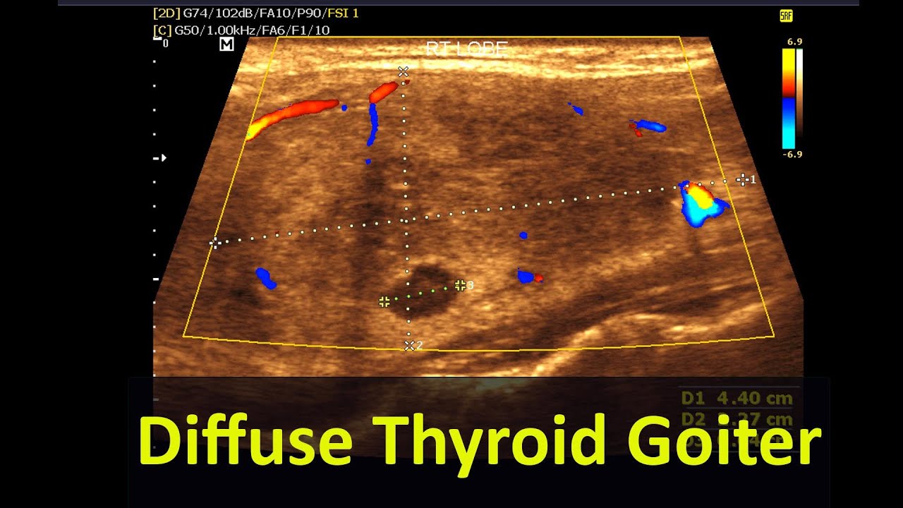 Ultrasound cases 39 of 2000 - || Video Showing Diffuse Thyroid Goiter ...