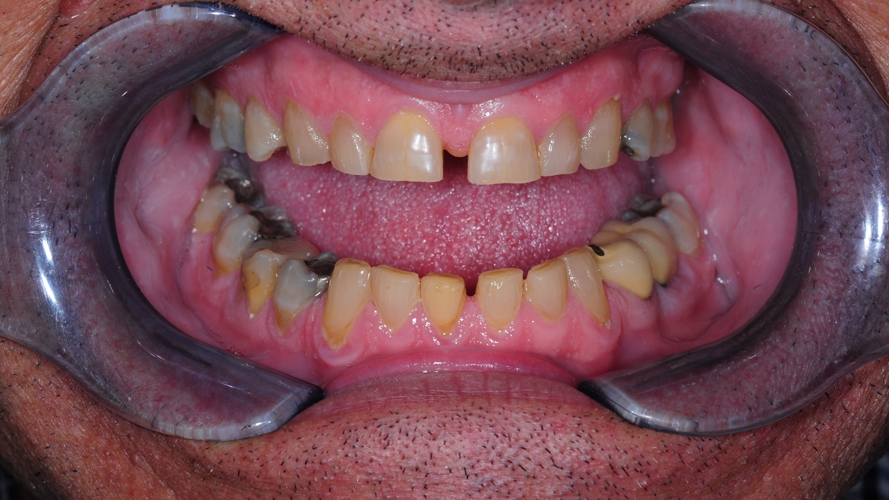 Full Smile Reconstruction with Jack Ringer DDS - YouTube