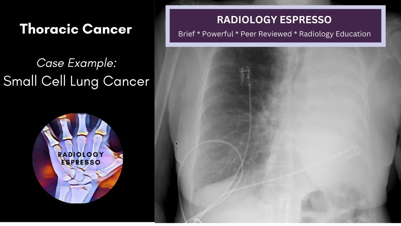 THORACIC CANCER: Case Example - Small Cell Lung Cancer - YouTube