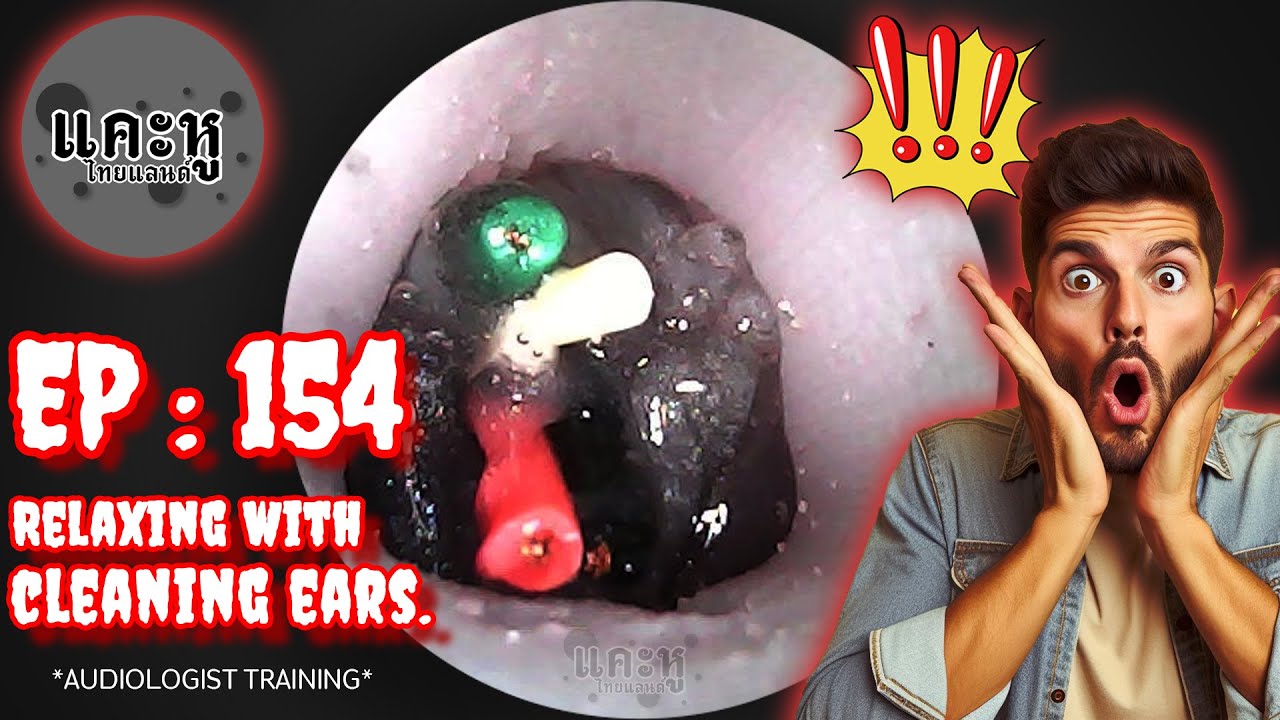 !!!อะไรอยู่ในหู!!! : What's in the ear? : EP 154 #ear #earwaxremoval # ...